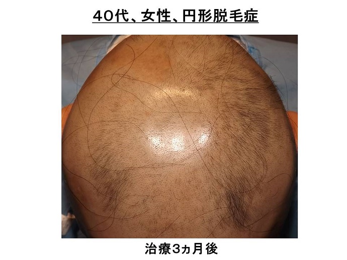 傷んだ毛が多いと、生え変わりを経て、その後に、産毛が一斉に生えてきます！ 患者様からの声・メディア掲載・クリニックからのお知らせ 名古屋